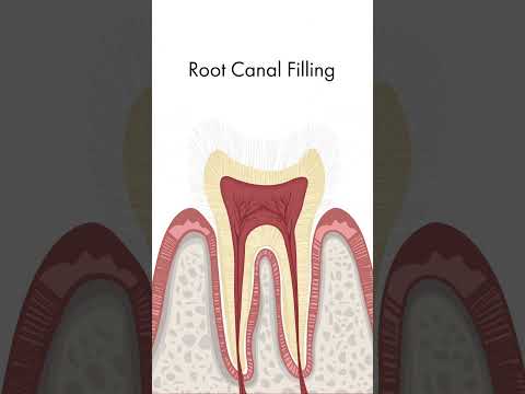 AEEDC 2024 Well-Root ST Clinical Application