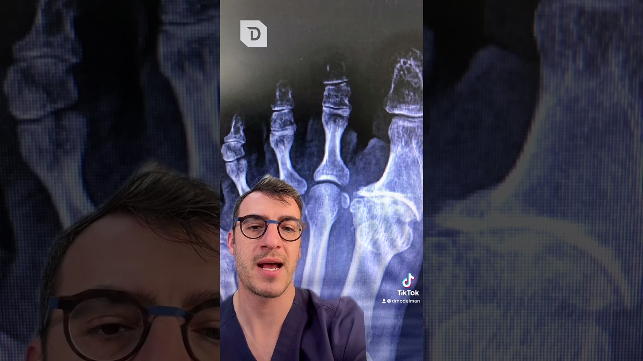 Big toe arthritis. Fuse it!!