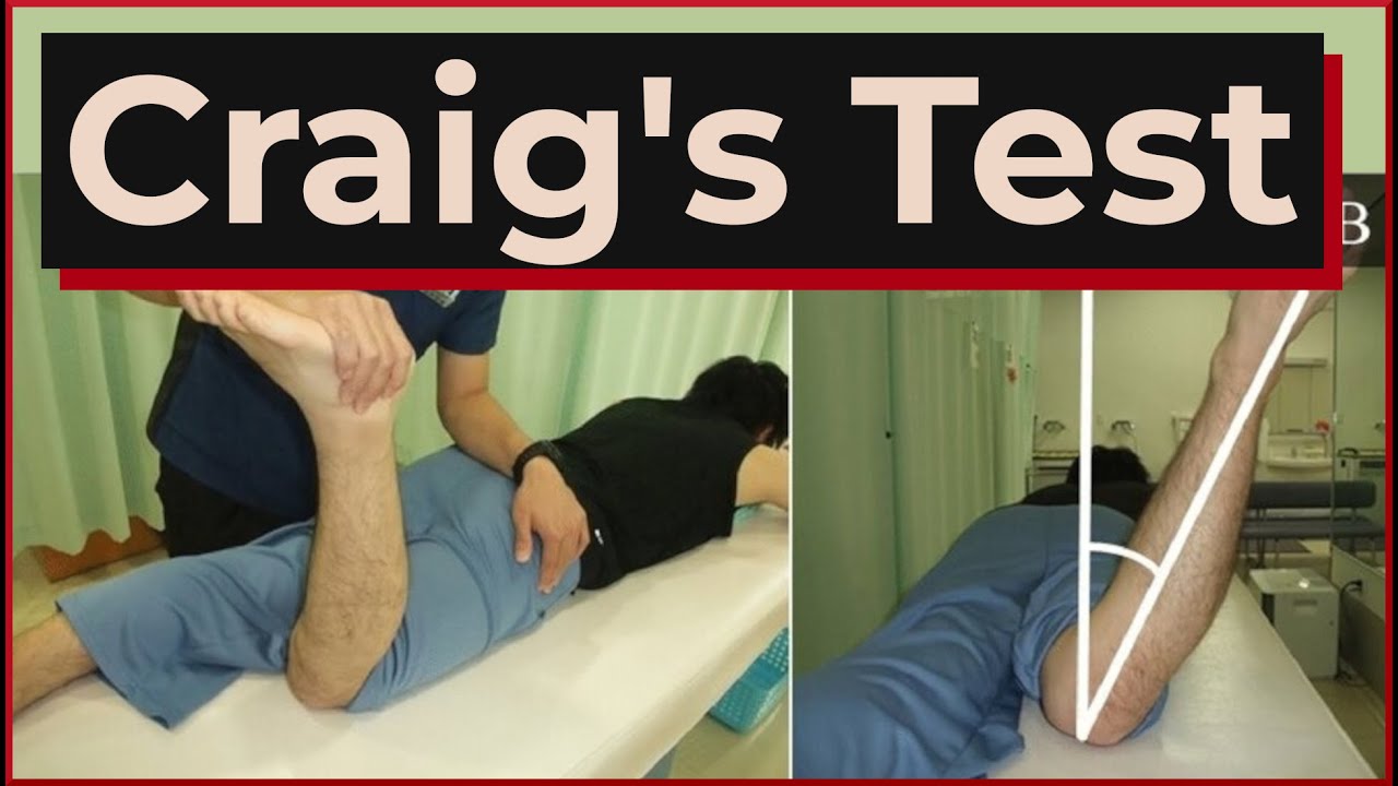 Craig's Test | Femoral Anteversion & Hip Alignment