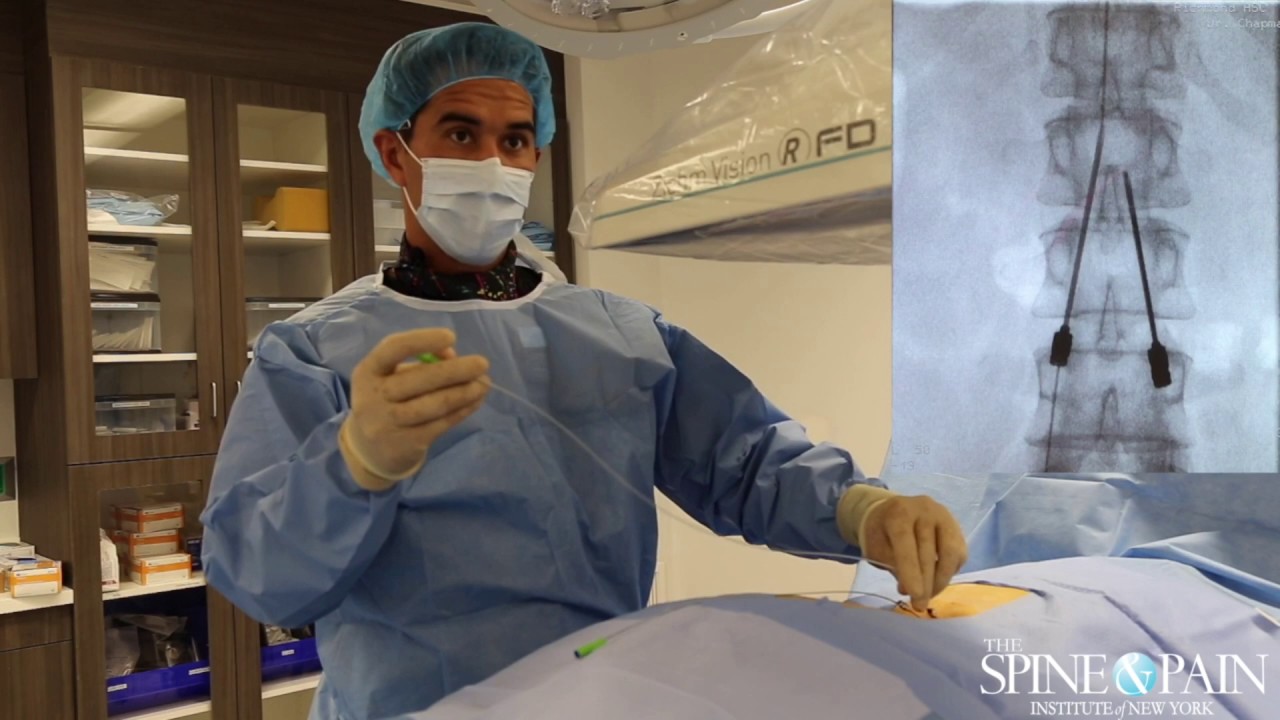 Spinal Cord Stimulator Trial