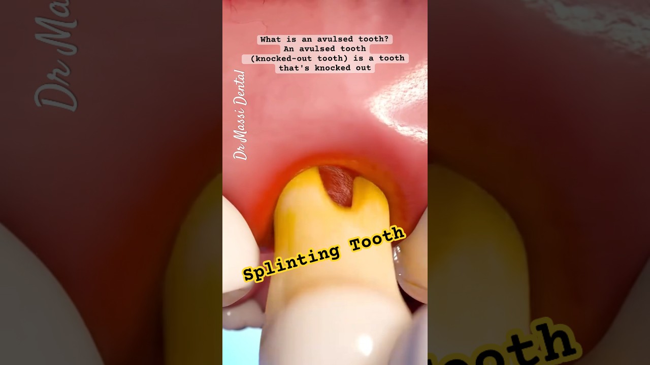Splinting Teeth immediately
