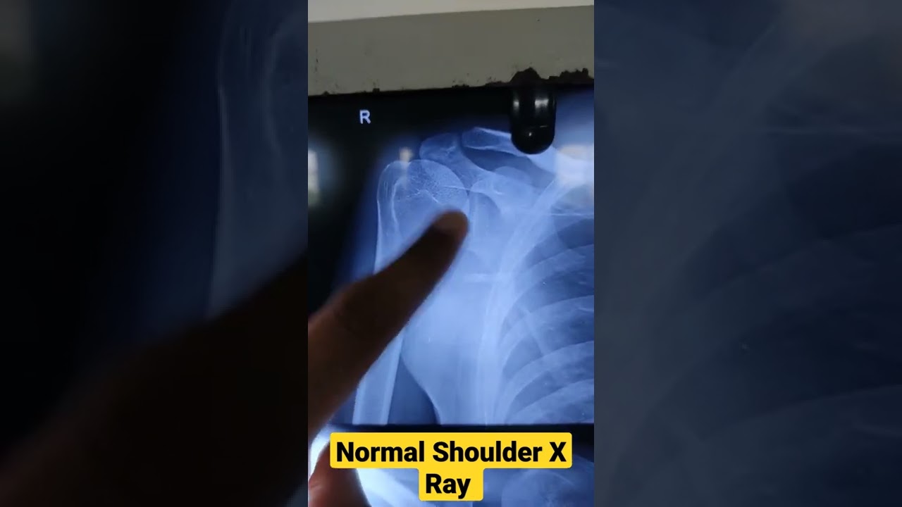 Normal Shoulder X Ray...Dr Sai Chandra MBBS DNB Ortho