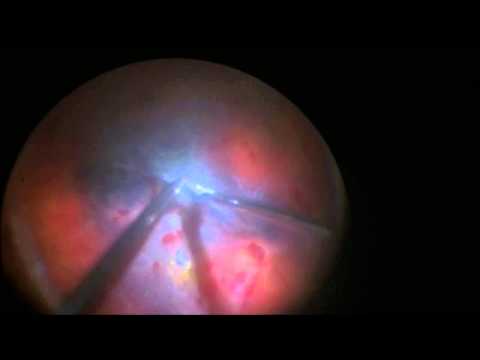 Tractional Retinal Detachments (TRD), proliferative diabetic retinopathy (PDR)