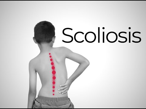 Well Advised: Scoliosis