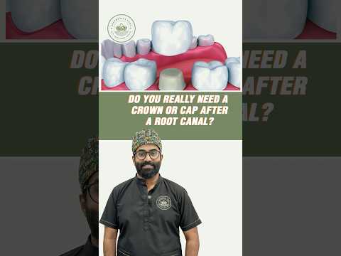 The Importance of Caps/Crowns After Root Canal Treatment - Dr. Manas Chakravarthy | Aesthetica Veda
