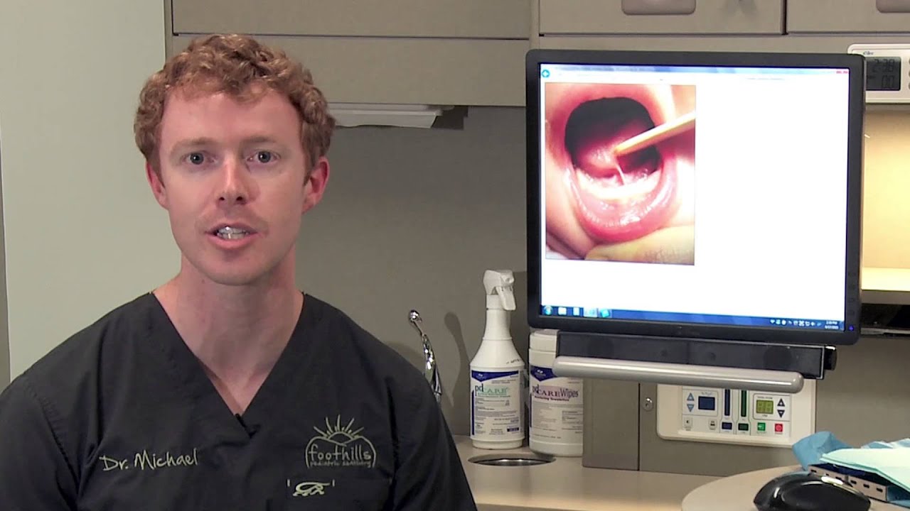 Tongue tie and the Frenulectomy procedure