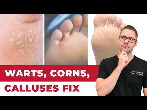 Heloma Durum - The Complete Diagnosis and Treatment Guide!