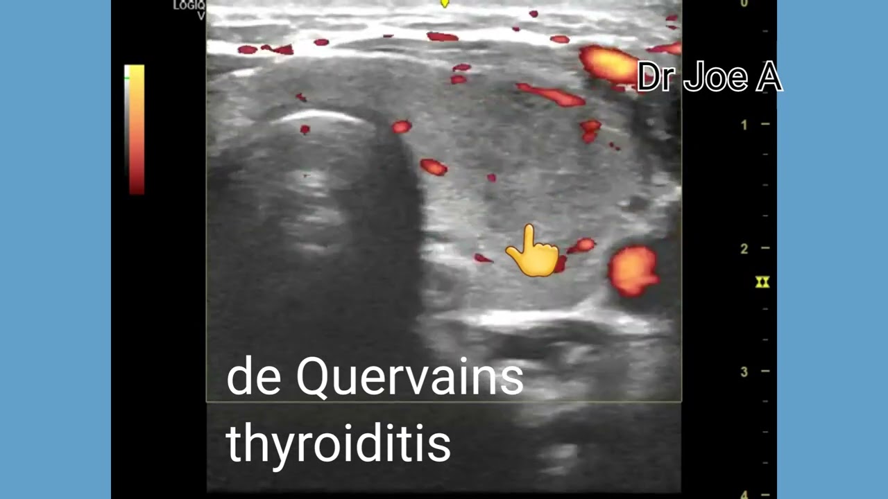 De Quervains thyroiditis or subacute granulomatous thyroiditis, ultrasound and color Doppler video