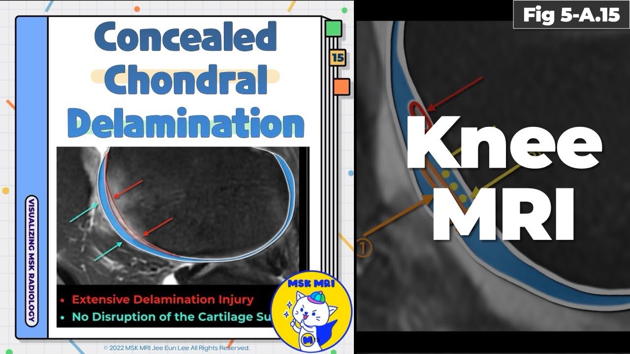 (Fig 5-A.15) Concealed Chondral Delamination