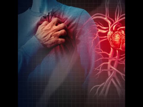 Post-PTCA Stenting in LCX Vessels #shorts #angiography