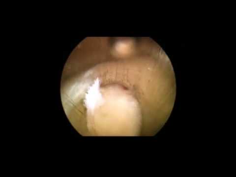 PELD interlaminar approach (PEID)