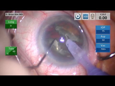 The Best Way To Do Cataract Surgery #28: Why I Developed Mechanical Fracturing and Recommend To All