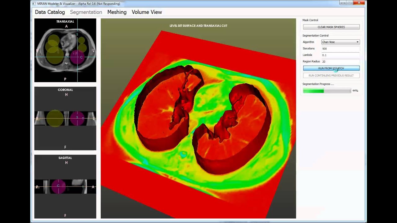 Interactive Level Set Segmentation