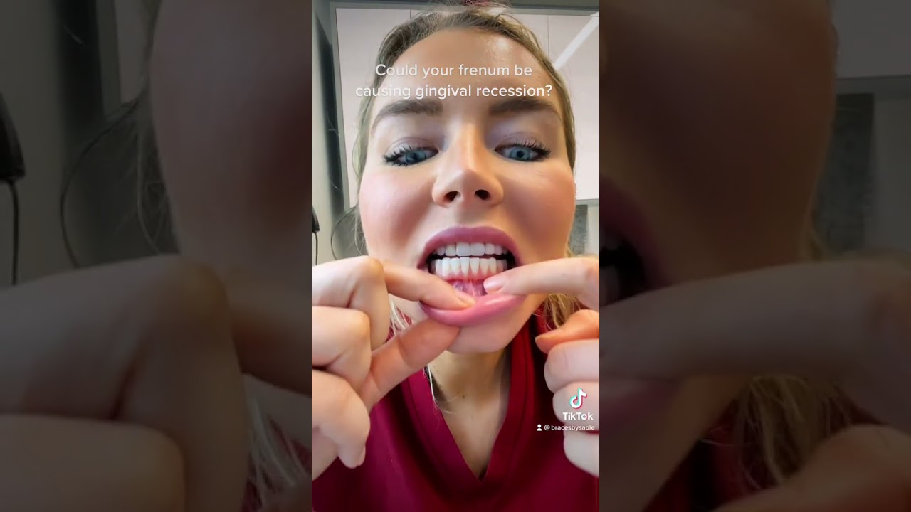 Frenum attachment! #doctor #frenum #frenumattachment #gingivalrecession
