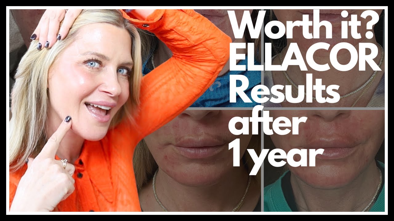 SAGGING skin: IS ELLACOR the answer? I spent a YEAR finding out for you! With before and afters!