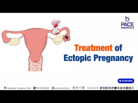 Treatment of Ectopic Pregnancy | Management of Ectopic Pregnancy #ectopicpregnancyawareness