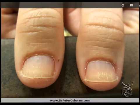 Thyroid Finger Nail Signs | TrulyGlutenFree