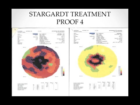 Stargardt Macular Dystrophy Treatment Proof – Visual Field Tests Results