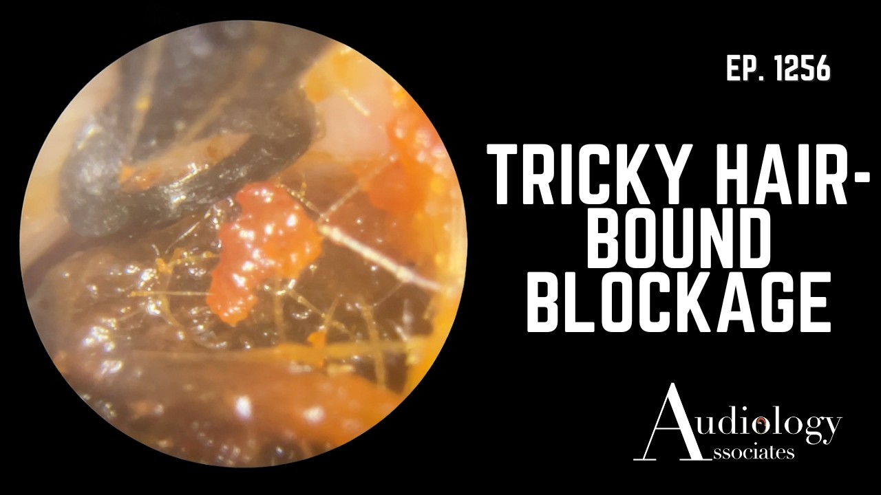 Significant Ear Wax Blockage Removed | Hair-Bound Build-Up in One Ear Canal - EP1256