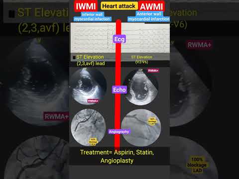 Heart attack💔 l AWMI l IWMI l #ecg #echo #angiography #shorts