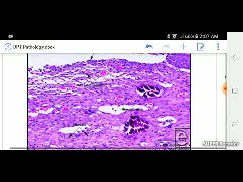 Granulation Tissue Pathology Definition Types Clinical Complications explained @MjeeLectures