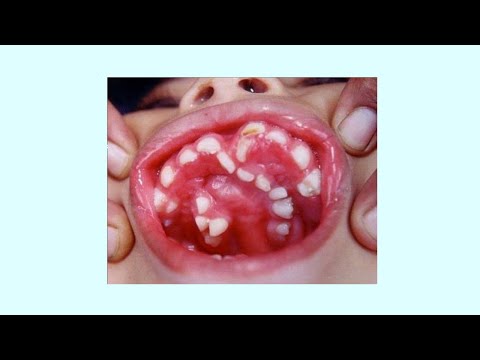 multiple supernumerary teeth