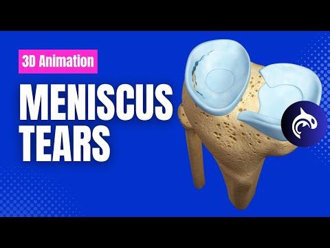 Meniscus Tears - Condition, Treatment, and Surgery - 3D Animation