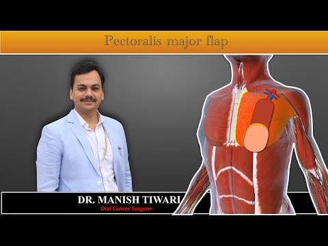 Pectoralis Major flap – Dr. Manish S. Tiwari – Oral Cancer Surgeon