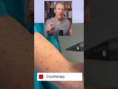 Cryotherapy demonstration Solar Lentigo: dermatologist explains #SHORTS