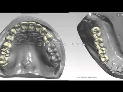 Full mouth rehabilitation 3shape. Milled provisionals and wax-up
