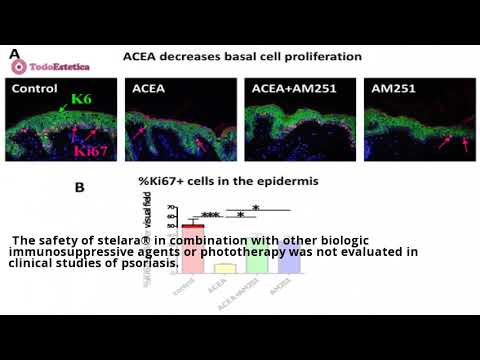 STELARA® (ustekinumab) for Plaque Psoriasis Treatment