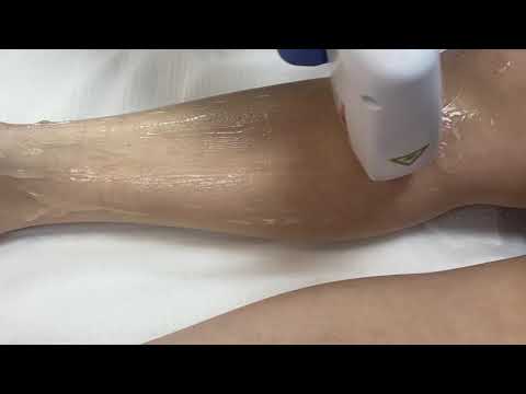 SMARTDiode Pro : Pain Free & Super-Fast Laser hair removal for all skin types.