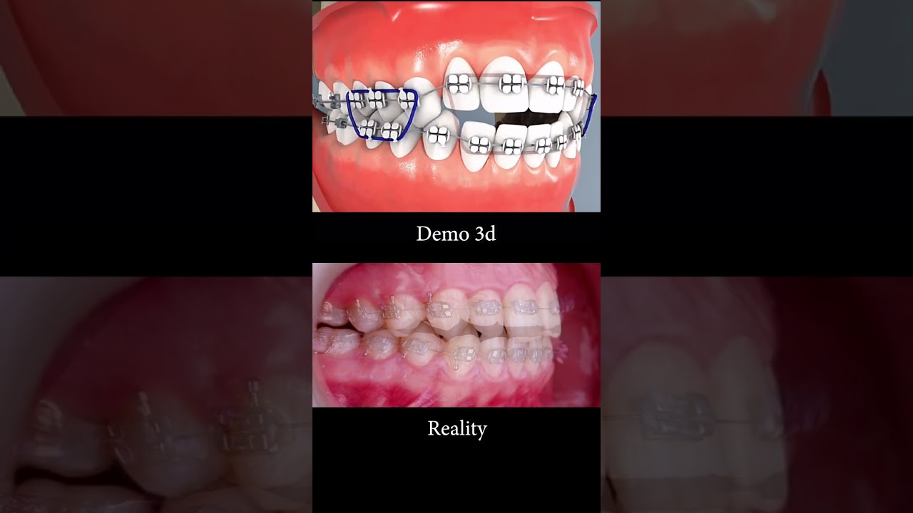 3D and realistic braces