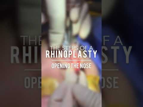 The Steps of a Rhinoplasty: Opening The Nose