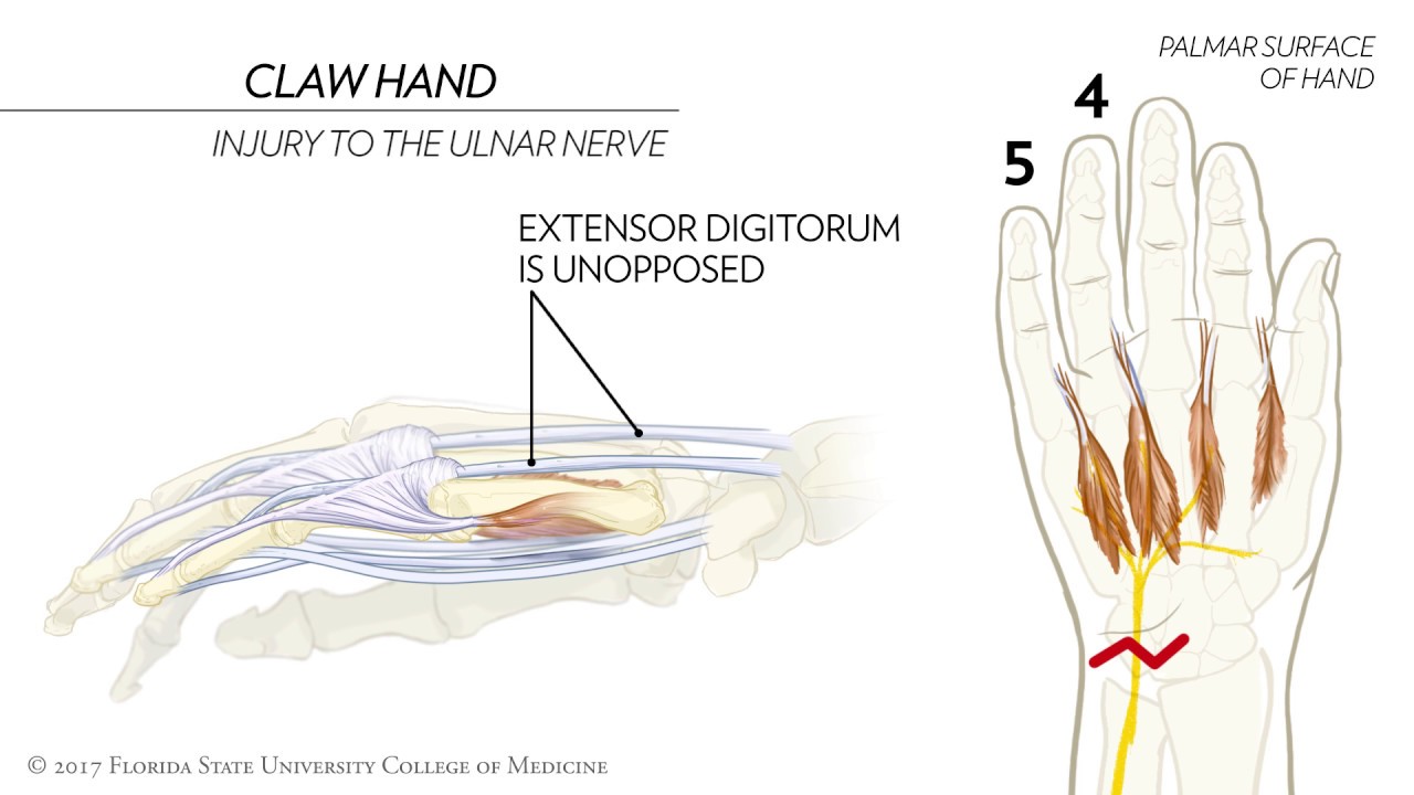 Claw Hand, Ape Hand, and the Sign of Benediction: Animated Review