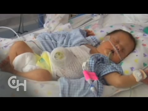 Delivery and Treatment of Babies with Omphalocele (7 of 11)