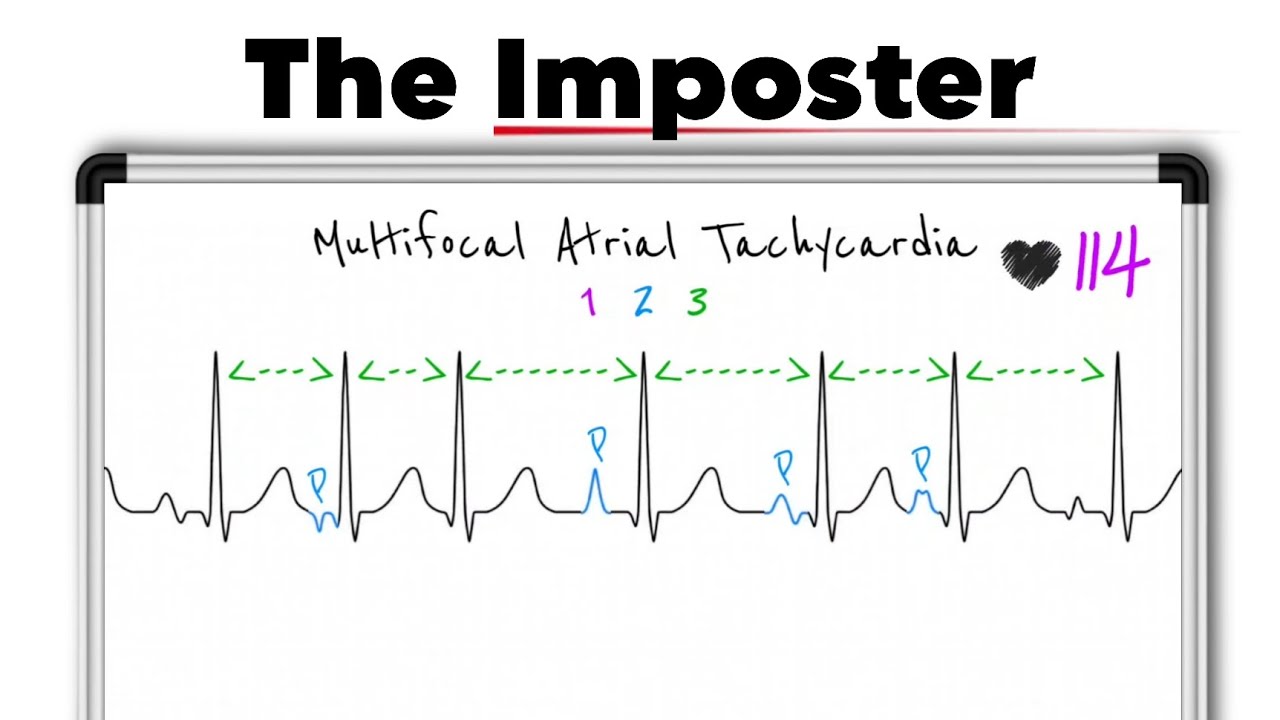 Multifocal Atrial Tachycardia (MAT) Explained | ECG Interpretation Made Easy