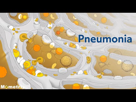 Pneumonia