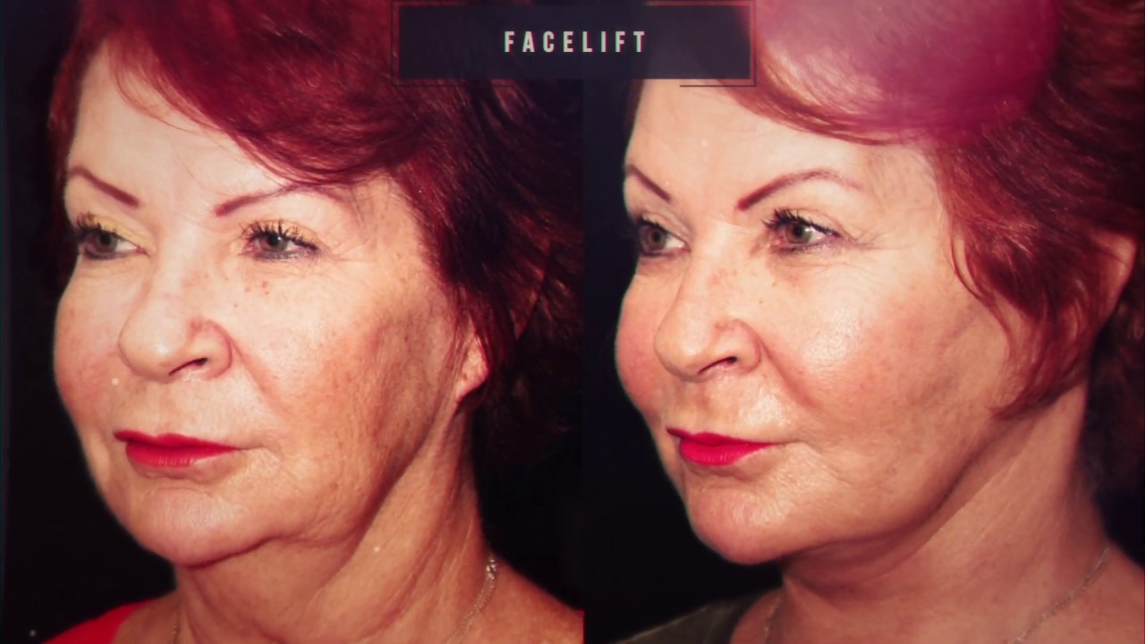 Solomon Facial Plastic Before After Series #42