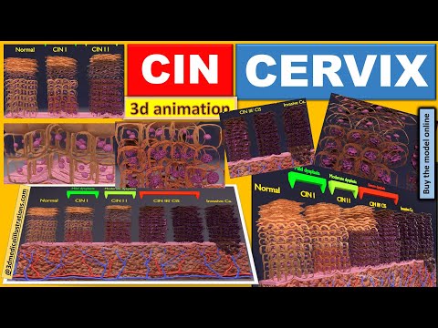 STL file Cervical cancer dysplasia CIN 3D model・3D printable model to ...