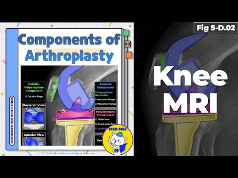 (Fig 5-D.02) Components of Posterior Stabilized Total Knee Arthroplasty