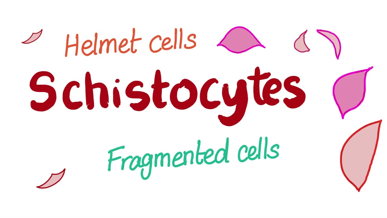 What's a Schistocyte? (aka Helmet cell or fragmented cell)