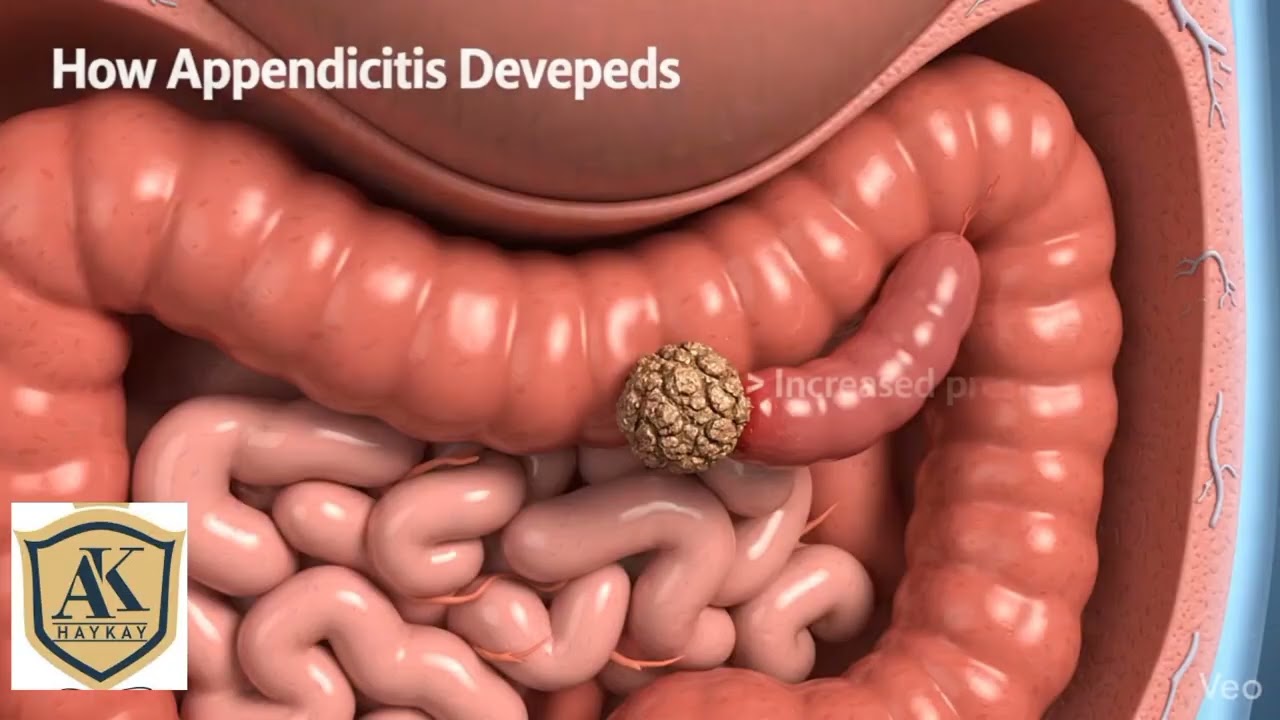 Welcome to this educational presentation on Appendicitis. 