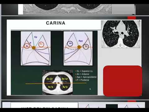 LUNGS SEGMENTAL ANATOMY ON CT