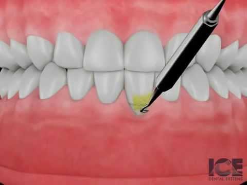 Dr. Eastman, Periodontist in Lakewood, FL Shares Patient Education Video on Connective Tissue Graft