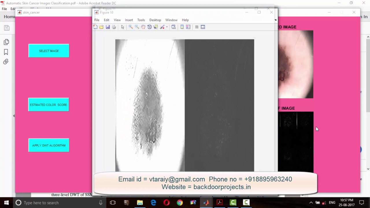 SKIN CANCER USING  DWT & CANNY ALGORITHM IN  MATLAB