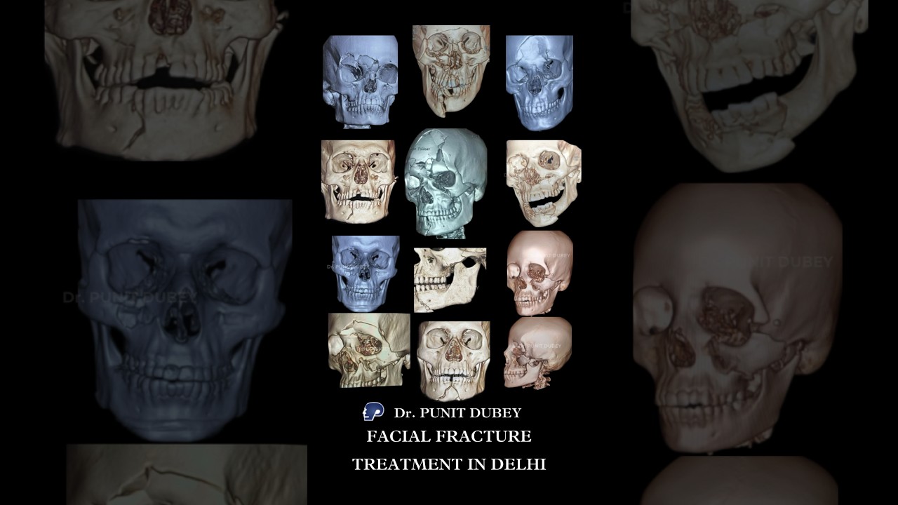 Facial Fracture Treatment in Delhi by Dr. Punit Dubey 💫 Face Expert