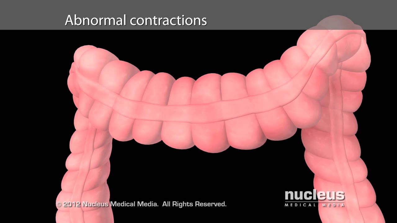 Irritable Bowel Syndrome (IBS)