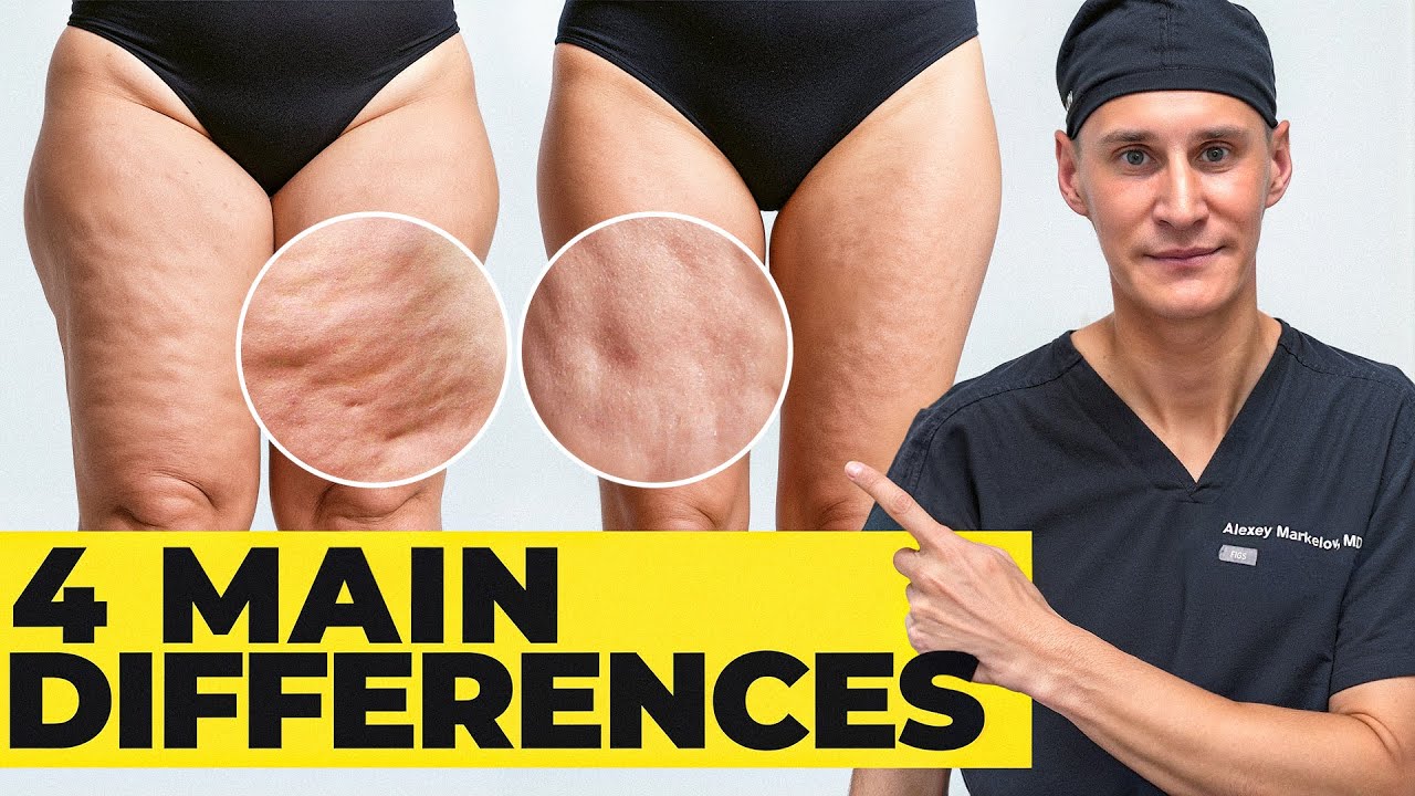 Cellulite or Lipedema? Get the Right Diagnosis