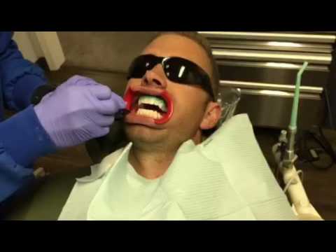 Permanent teeth whitening-KoR Whitening for simply whiter teeth!